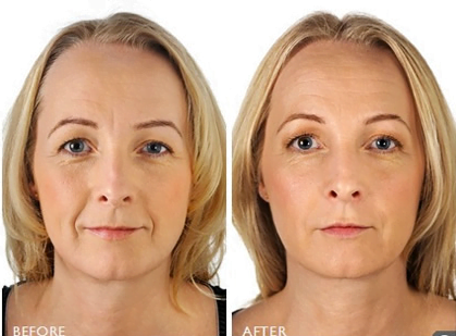 Perlane: Benefits and risks of this filler – Healthynewage.com