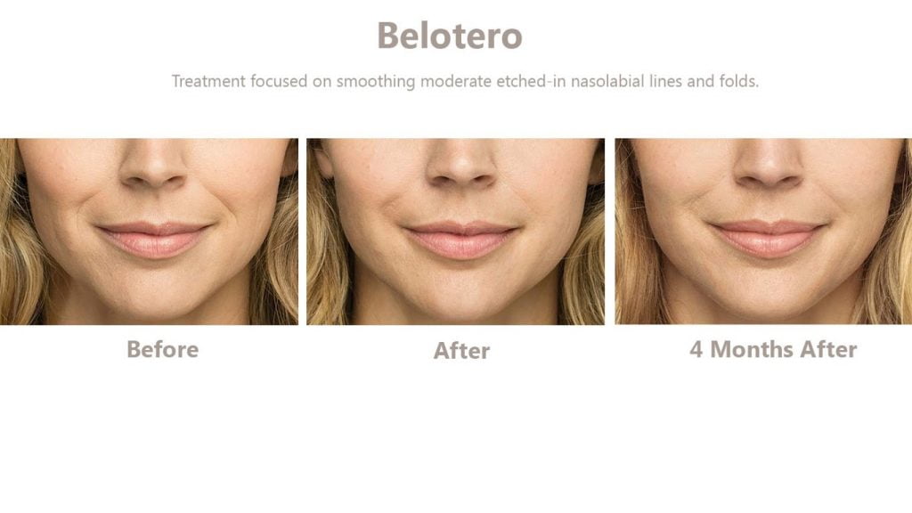 The filler Belotero. Its benefits and the risks – Healthynewage.com